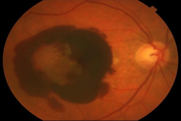 Hemovitreo Retin logo En Quito Hemovitreo Retin logo En Quito